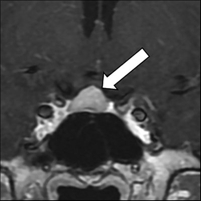 A False Pituitary Tumor | Endocrine Society