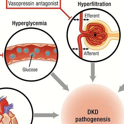 Mechanisms and Therapy for DKD | Endocrine Society