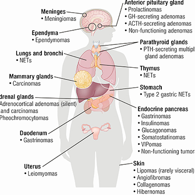 MEN1 Latest Insights | Endocrine Society