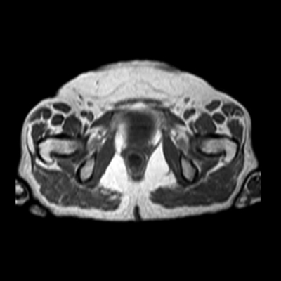 Pelvis Magnetic Resonance Imaging to Diagnose Familial Partial ...